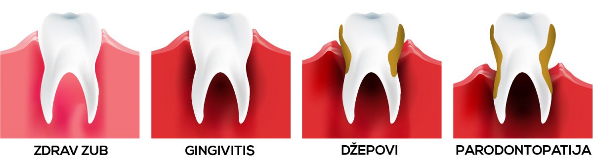 Lečenje paradentoze laserom - Novi Sad | Dental Centar Bobić, Novi Sad