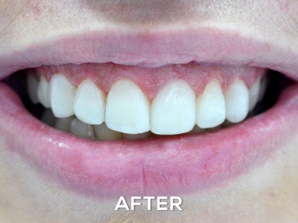 Viniri / Fasete za zube cena 220€ | Dental Centar Bobić, Novi Sad - Srbija