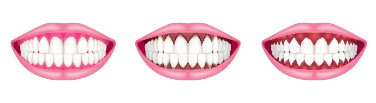 Lečenje paradentoze laserom - Novi Sad | Dental Centar Bobić, Novi Sad