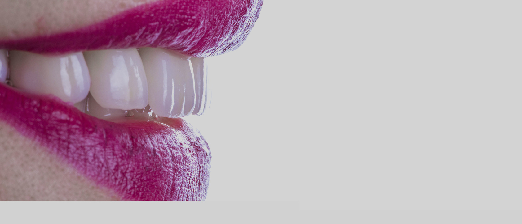 viniri 3 | Stomatolog Novi Sad | Dental Centar Bobić, Novi Sad